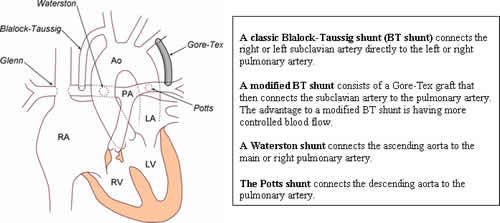 Blalock Taussig Shunt Scar