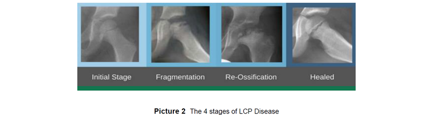 Legg Calve Perthes Disease