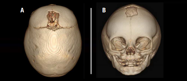 Cranial Dents