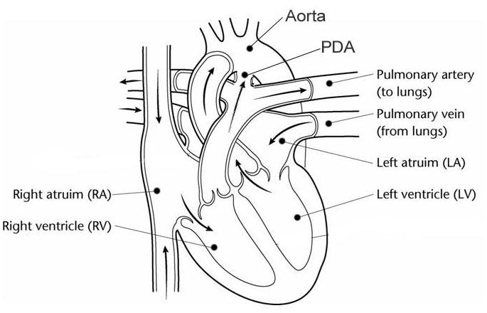 Patent Ductus Arteriosus