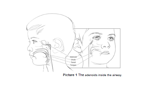 Adenoidectomy Before And After
