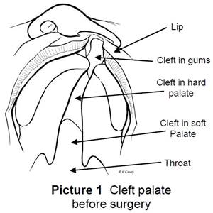 Cleft Palate Surgery Procedure