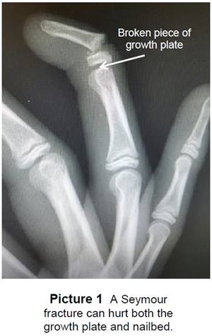 Broken Index Finger X Ray