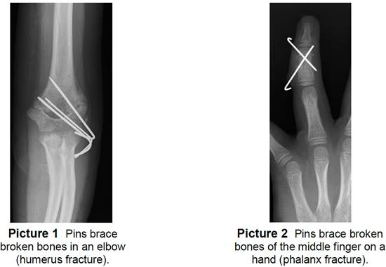Broken Pinky Finger X Ray