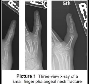X Rays Of Broken Fingers