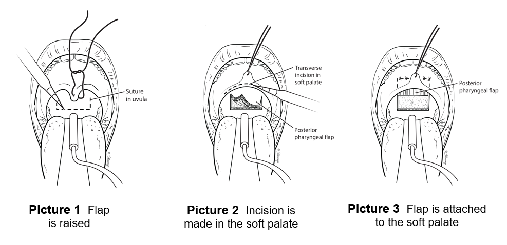 Velopharyngeal Dysfunction