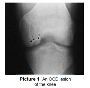 Osteochondritis Dissecans Knee