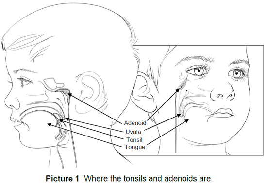 Before And After Tonsillectomy