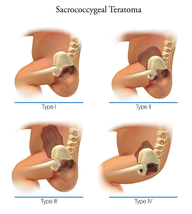 Sacrococcygeal Teratoma In Adults