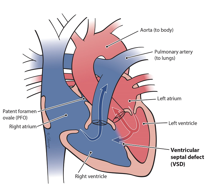 Ventricular Septal Defect Ventricular Septal Defect (VSD)