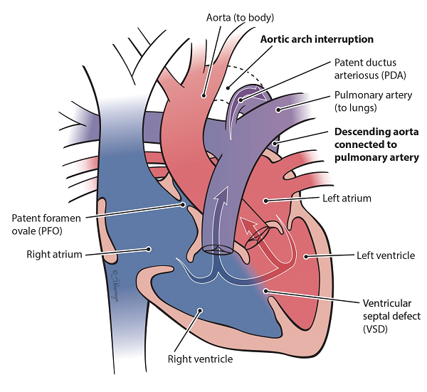 Aortic Arch Incidentally Detected Noninfectious Thoracic Aortitis: A