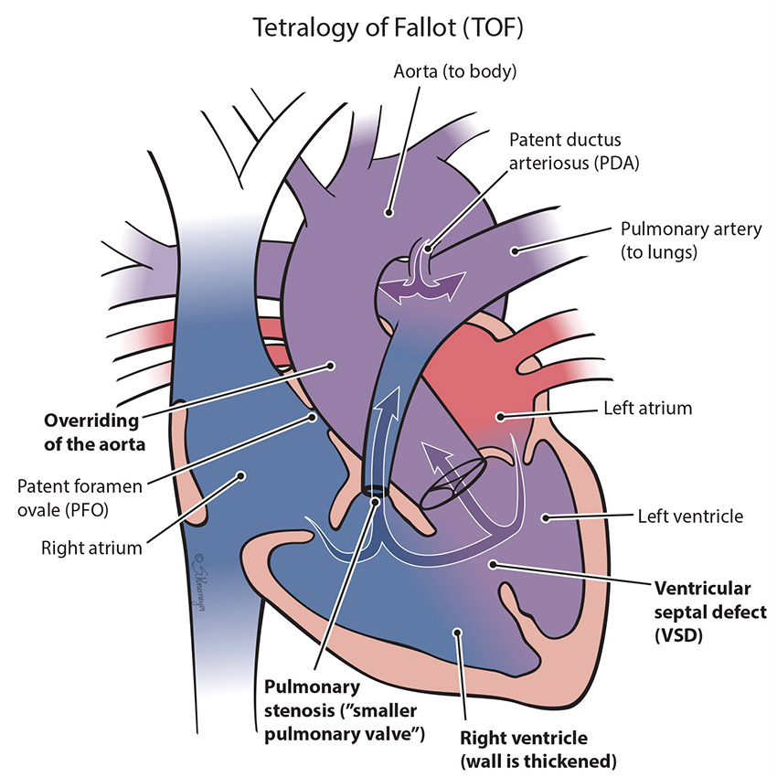 Endocardial Cushion Defect