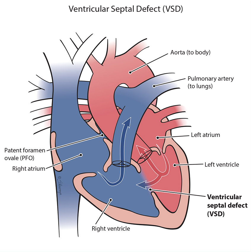 Atrial Ventricular Septal Defect