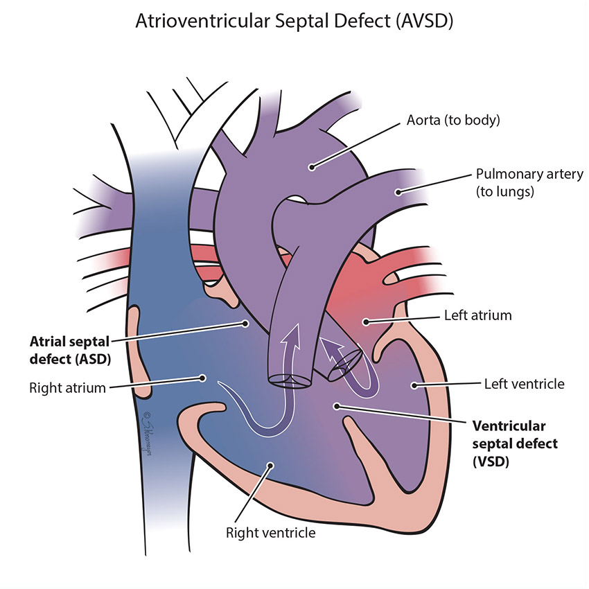Atrioventricular Septal Defect