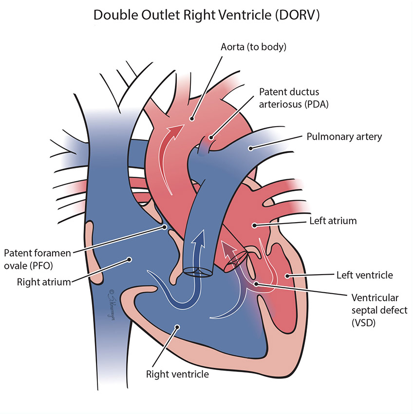 Double Inlet Left Ventricle